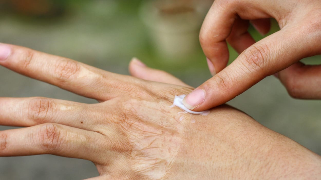 Werkt vitamine E tegen littekens?