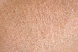 Wat te doen bij een craquelé huid? | ALHYDRAN