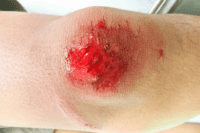 Hoe moet je een schaafwond behandelen? | ALHYDRAN