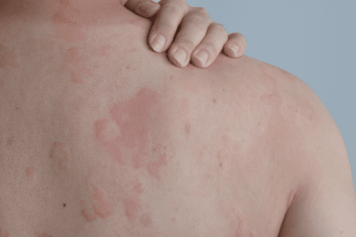 Jeukende bultjes: oorzaken en oplossingen | ALHYDRAN