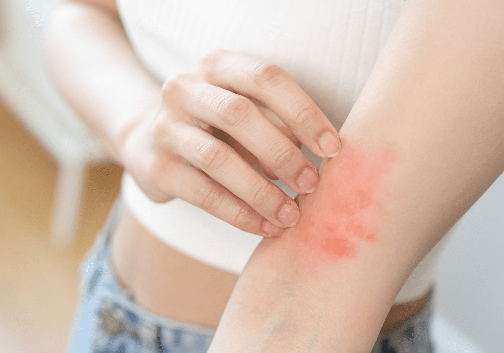 Jeukende bultjes: oorzaken en oplossingen | ALHYDRAN